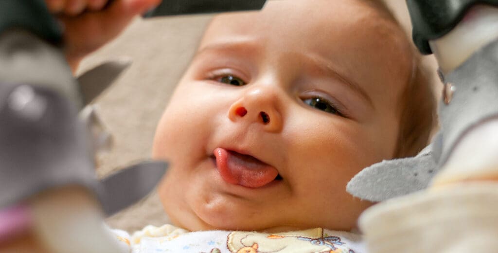 Frenectomy | tongue and lip ties | Park Pediatric Dentistry