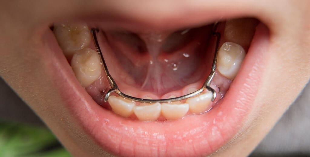 Space maintainers | Park Pediatric Dentistry